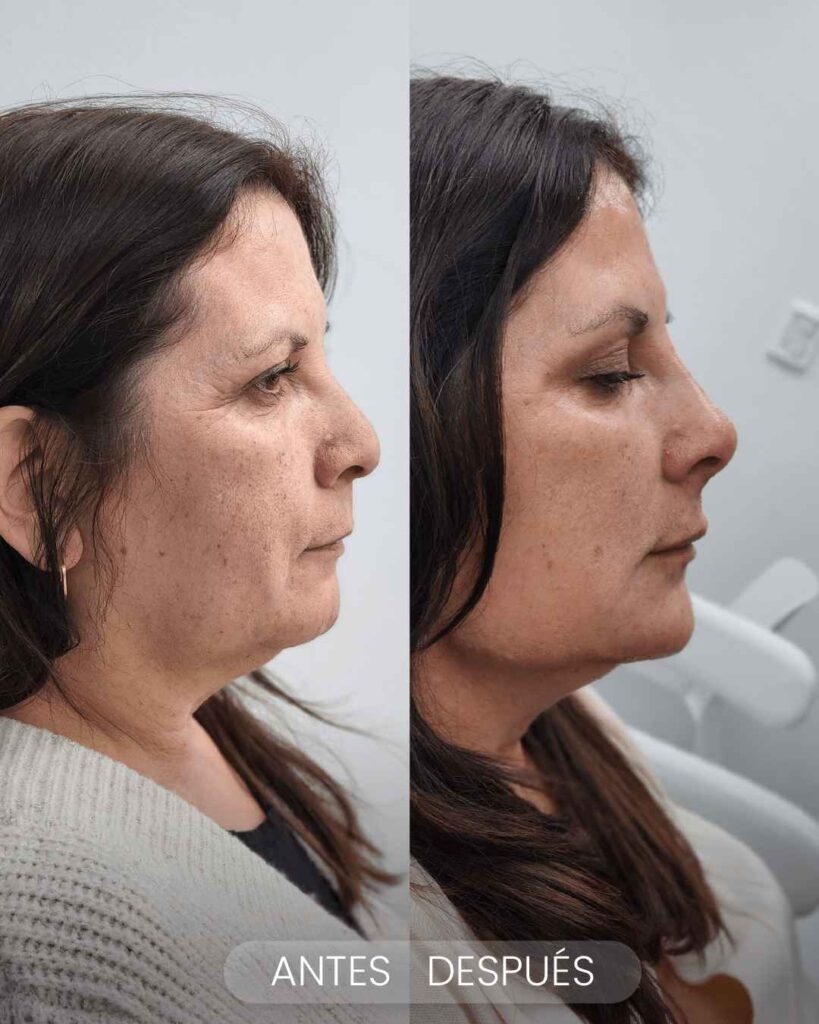 Perfilado mandibular - Clínica BeYou