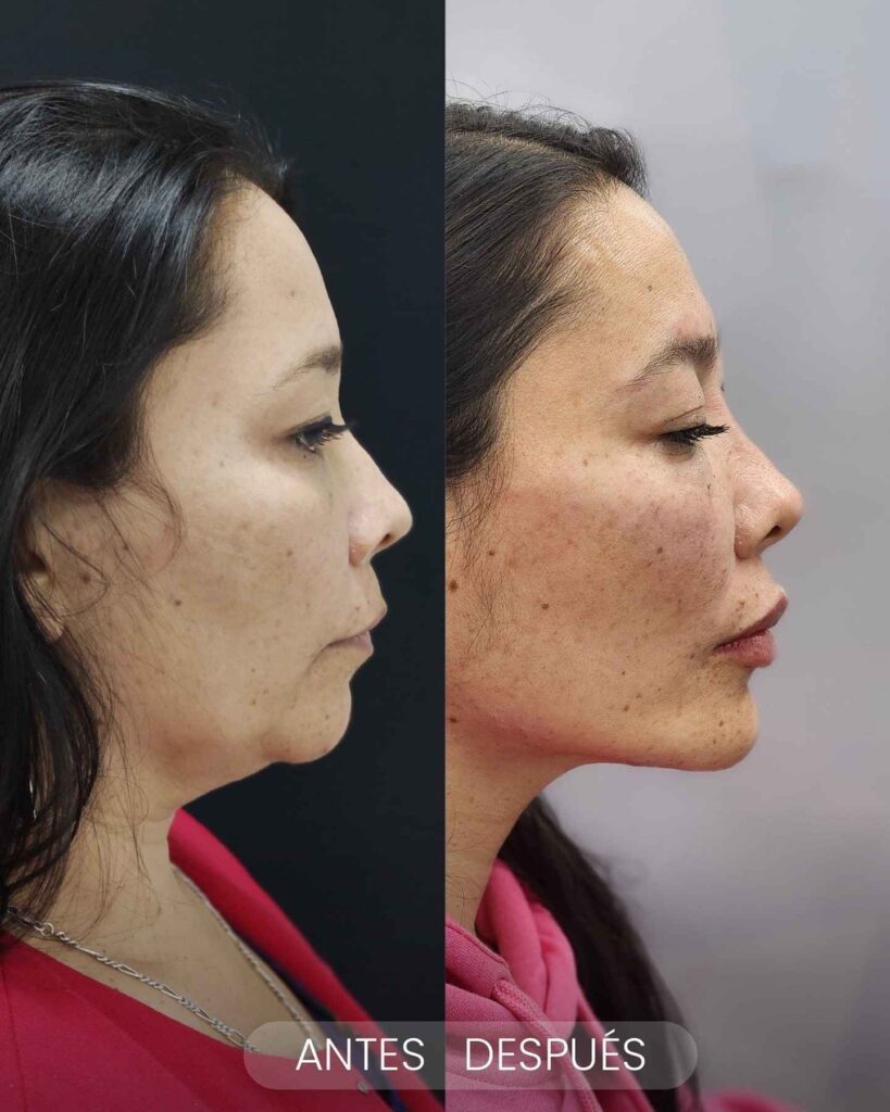 Perfilado mandibular - Clínica BeYou