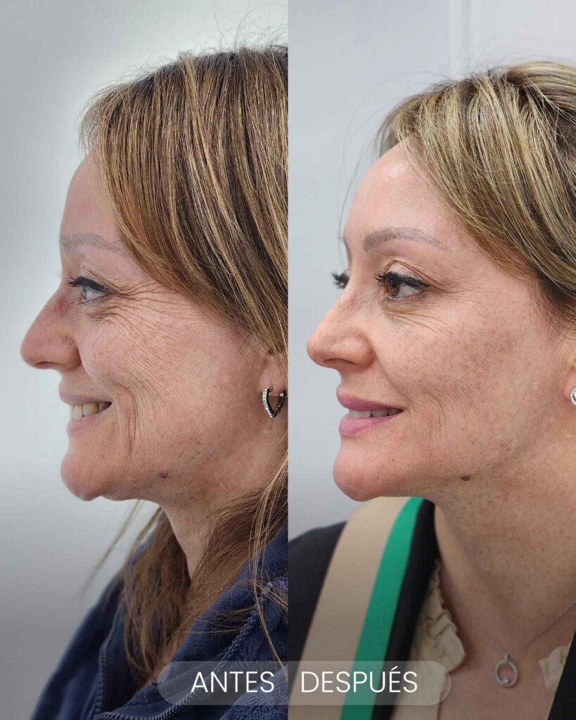 Perfilado mandibular - Clínica BeYou
