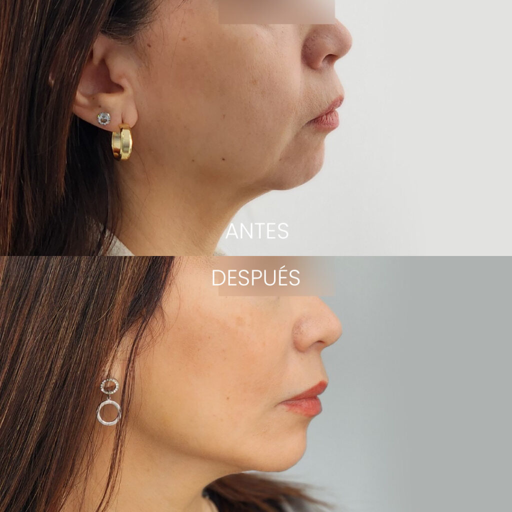 Perfilado mandibular: Define tu rostro sin cirugía - Clínica BeYou